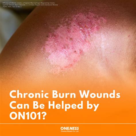 Oneness Biotech Co Ltd On Linkedin Burn Wounds Granulation Tissue