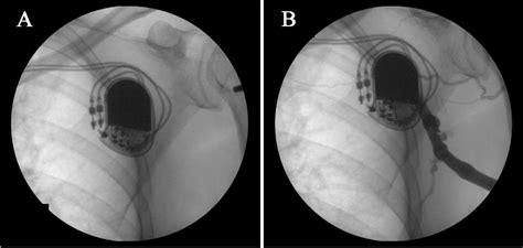 figure 1 from intermittent positional axillary vein compression a
