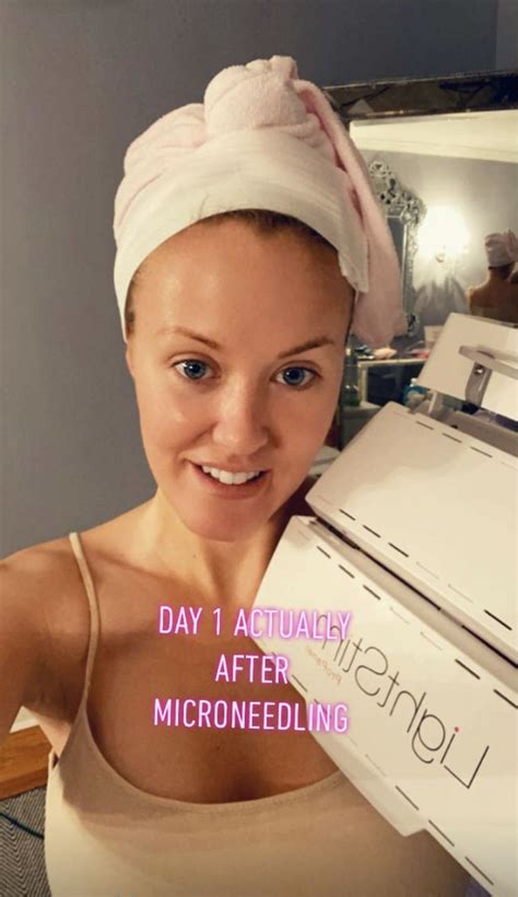 Pin By Skin By Abby Llc On Micro Needling Microneedling Micro