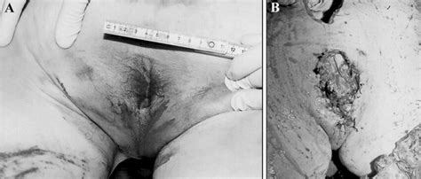 A B The Surgical Wound Length Cm In The Genital Area During The Download Scientific