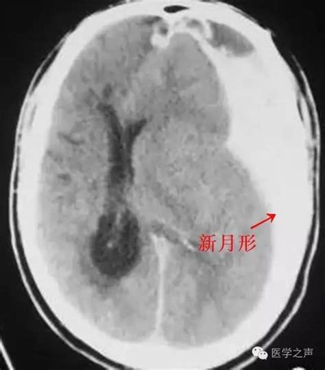 急性硬膜下血肿ct图片 硬膜下血肿ct表现图片 伤感说说吧