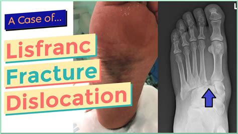 Lisfranc Fracture Dislocation Meded Cases