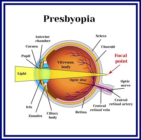 What Is The Difference Between Myopia Hyperopia And Presbyopia New Optical Palace
