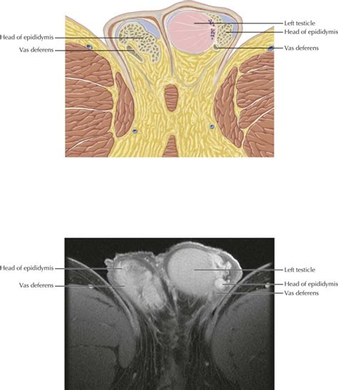 Scrotum And Testes Radiology Key
