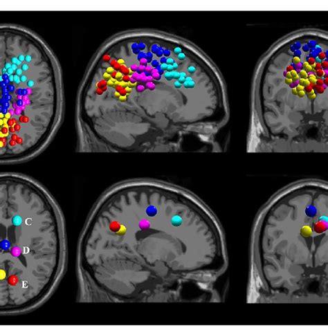 Eeg Source Localization Results For Sixteen Stroke Subjects During