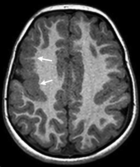 Akt3 Genetically Confirmed Mutation An Axial Spoiled Gradient Recalled