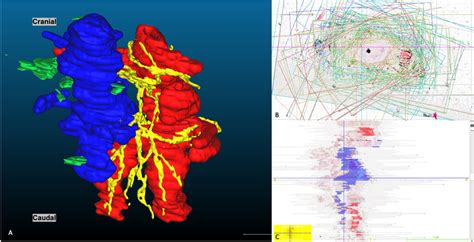 Destructive 3d Histological Reconstruction Group Ii Postmortem