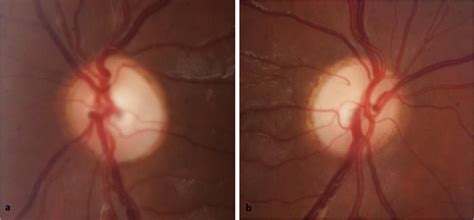Visual Field Perimetry 24 2 Showing Typical Bilateral Inferior Visual Download Scientific