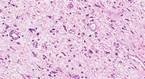 Dedifferentiated Liposarcoma Ottawa Atlas Of Pathology
