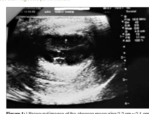 Figure 1 From A Case Of Cavernosal Abscess After Neglected Penile