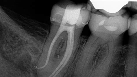 Irrigation Endodontics At Patrick Lauzon Blog