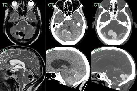 Dural Arteriovenous Fistula Neuroradiology