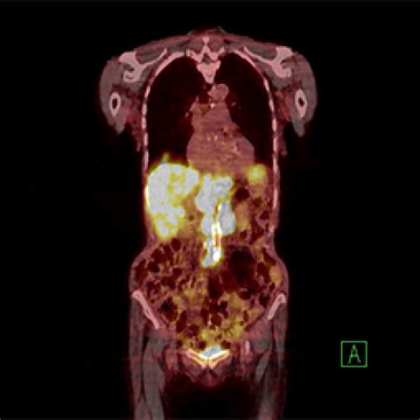 Faster Easier PET CT Scan Catches Tumors Northwest Community Healthcare