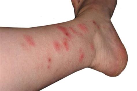 How Long Do Bed Bug Bites Last Take To Appear Go Away Heal Pestbugs