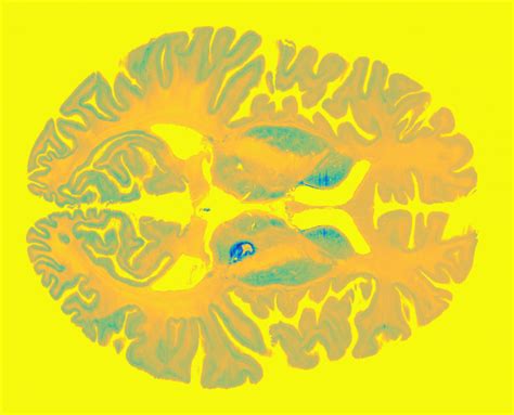 Lead Dbs A Matlab Toolbox Reconstruction And Visualization Of Dbs Electrodes Based On