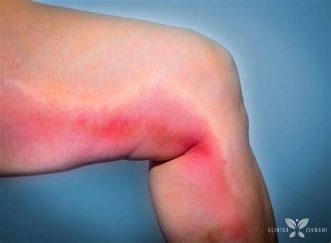 Tromboflebite Sintomas Riscos E Prevenção Clinica Zignani