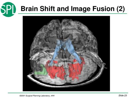 Ppt Tracking Volumetric Brain Deformation During Image Guided Neurosurgery Powerpoint