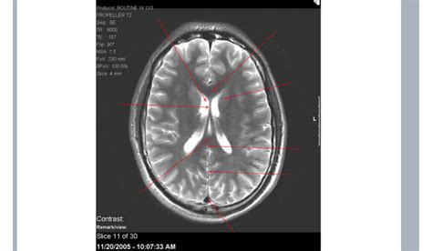 Brain Ct Scan Slice 5 Diagram Quizlet