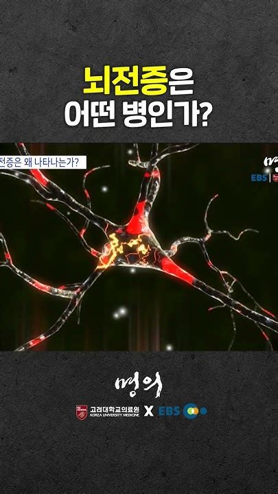 예측할 수 없는 발작이 반복되는 뇌전증 Youtube