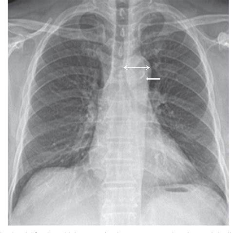 Figure 2 From The Clinical Significance Of Aortic Calcification In Chest Radiography In
