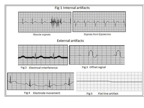Artifacts In Ecgpptx