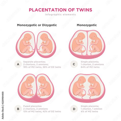 Twin Types Infographic Elements In Flat Design Monozygotic Or