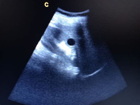 Renal Cyst Ultrasound