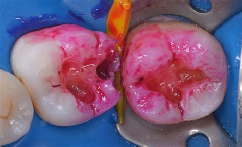 A Recipe For Class Ii Composite Restoration Myzerodonto