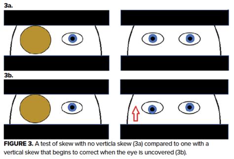 The Well Appearing Patient With Acute Dizziness Sinai Em