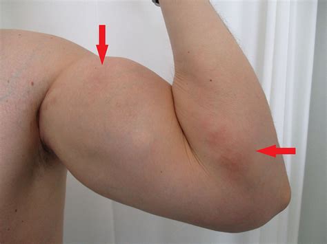 Synthol Injections Side Effects