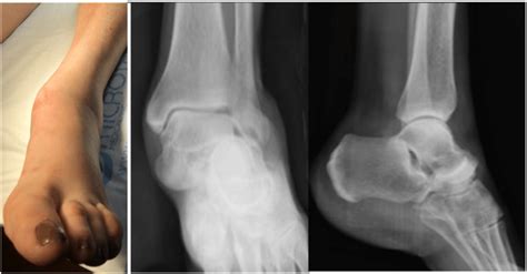 Clinical And Radiographic Presentation Of A Left Lateral Subtalar Download Scientific Diagram