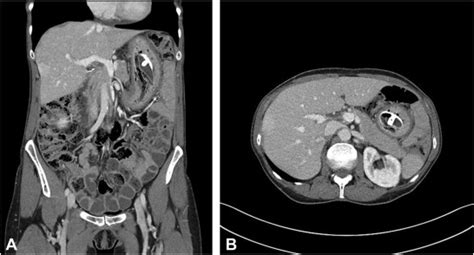 A Novel Method For Removal Of A Partially Deflated Intragastric Balloon