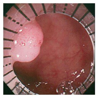 Three Methods To Measure Polyp Size Using The Calibrated Hood Download Scientific Diagram