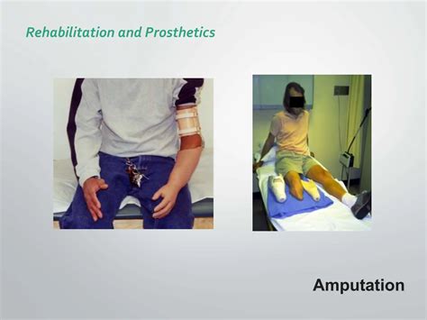 Amputation Orthopedics Mbbs With Types Pptx