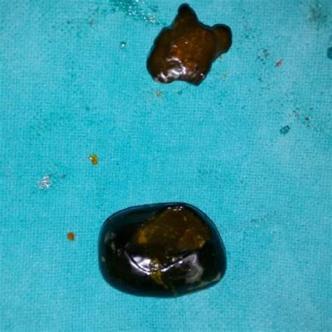 Image Of Retrieved Enterolith Download Scientific Diagram