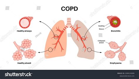 Chronic Obstructive Pulmonary Disease Copd Group Stock Vector Royalty