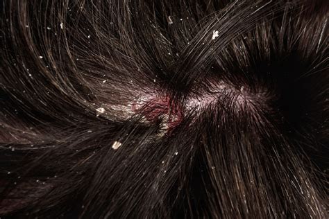 How To Get Rid Of Dandruff Stuck In Hair Dandruff Hair Scalp Remedies Natural Allura Trichology