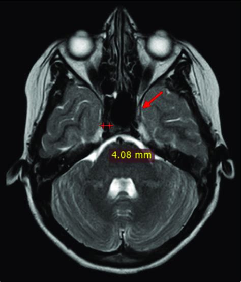 Axial T2wi Shows Measurement Of Diameter Of Right Cavernous Ica Flow Download Scientific