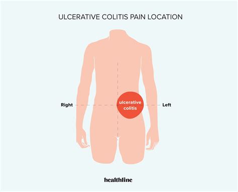 Left Sided Ulcerative Colitis Symptoms Slide Show What Is Ulcerative