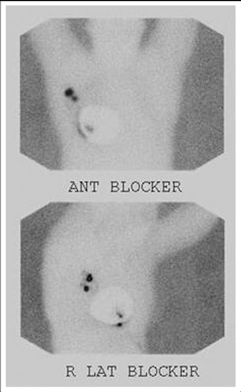 Table 1 From Administration Of Subcutaneous Buffered Lidocaine Prior To