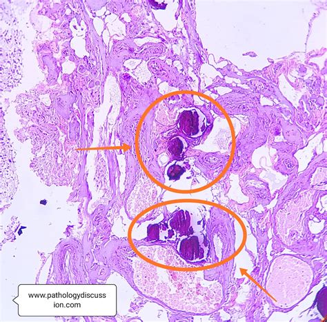 Faq On Pathologic Calcification Dystrophic Calcification Metastatic Calcification Psammoma Body