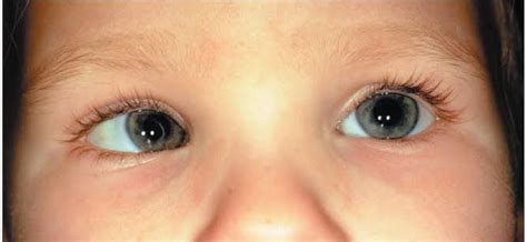 Clinical Types Of Ocular Deviation Optography