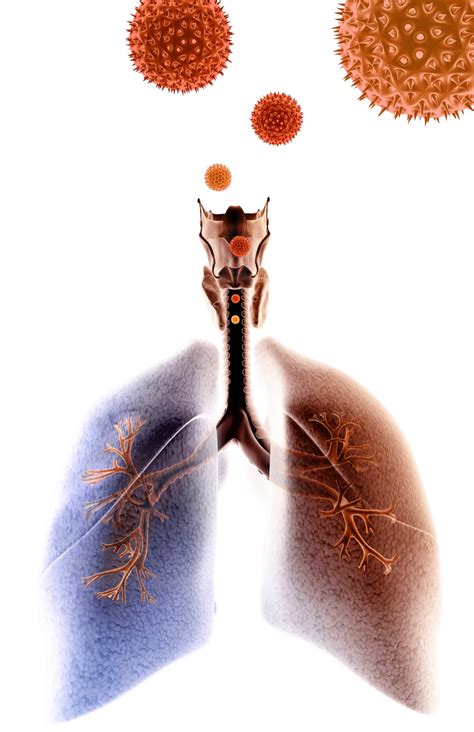 Breztri New Inhaler For Copd By Astrazeneca Los Angeles Allergist