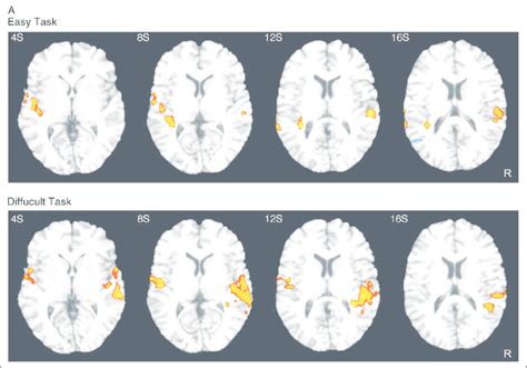 A Statistical Parametric Maps Of Activation P