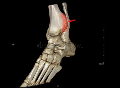 Distal Tibia Stock Illustrations 433 Distal Tibia Stock Illustrations Vectors And Clipart