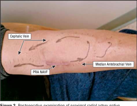 Figure 2 From Creating Arteriovenous Fistulas In 132 Consecutive Patients Exploiting The