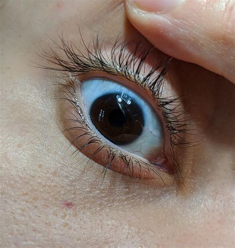 Distichiasis Eyelashes