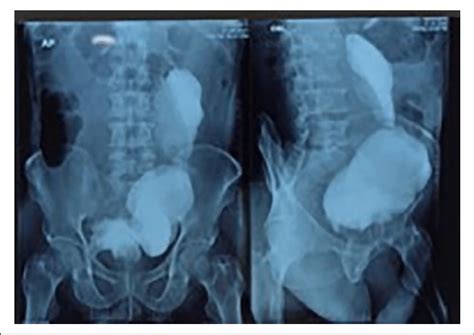 Bladder Diverticulum Vcug