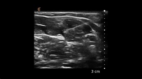 Median Nerve Block Clarius