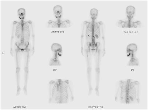 A Bone Scan Image Shows Increased Technetium 99 Uptakes In Both